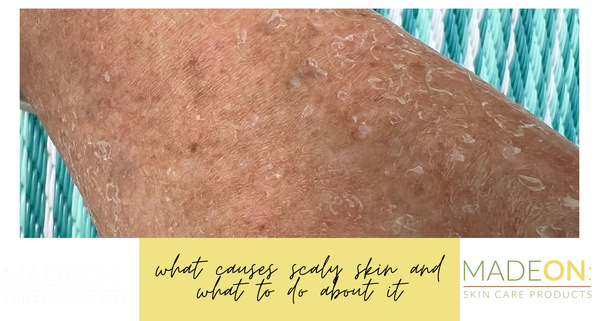 Dry, Flaky Scaly Skin: Causes and Solutions – MadeOn Skin Care